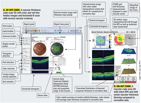 The Anatomy Of An OCT Scan