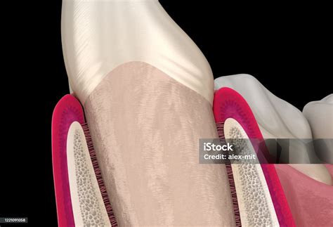 상악 측면 절개 치아와 잇몸의 형태 의학적으로 정확한 치과 3d 일러스트레이션 이빨에 대한 스톡 사진 및 기타 이미지 이빨 3차원 형태 개과 Istock