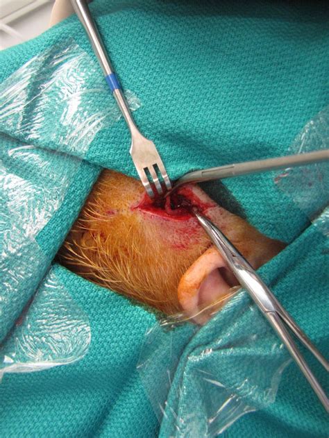 Temporal Arteritis Giant Cell Arteritis And Temporal Artery Biopsy Technique Iowa Head And