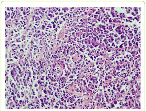 Breast Biopsy Showed Atypical Cells Forming The Neoplastic Metastatic