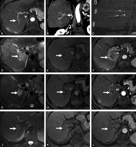 Typical Mri Appearance Of Hcc After Ire A B Baseline Axial And Download Scientific Diagram