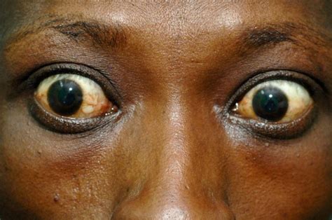 Why Do My Eyes Bulge Out At Bernadette Williams Blog
