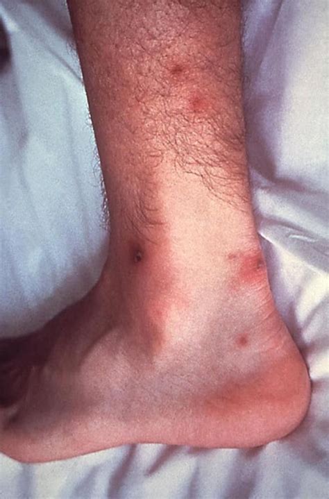 Gonorrhea Infectious Diseases Merck Manual Professional Edition