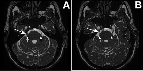 Trigeminal Neuralgia The BMJ