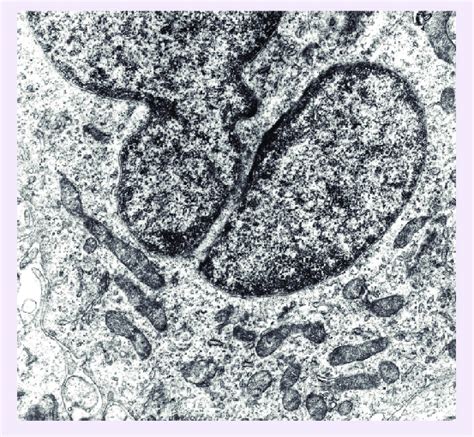 Ependymoma Cell From An Ependymoma Of The Fourth Ventricle The Cell