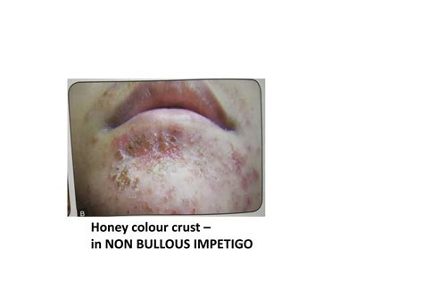 Classification Of Skin Lesions Pdf PDF