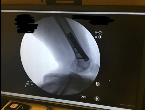 Non Ossifying Fibromas In My Femurs The Left One Was Removed More Info In The Comments R