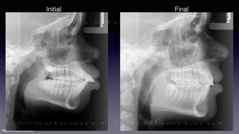Bimaxillary Protrusion Facial Harmony Dr Sylvain Chamberland