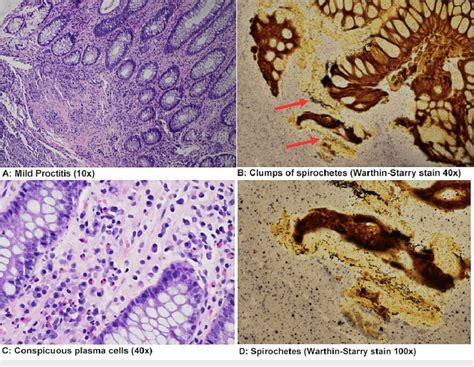 Histological Preparation Of Rectal Biopsy Capturing Mild Proctitis At