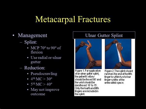 Ulnar Gutter Splint For 5th Metacarpal Fracture