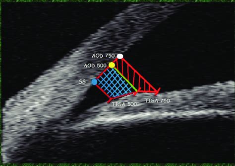Diagram Of The Quantitative Measurements Of The Anterior Chamber Angle Download Scientific