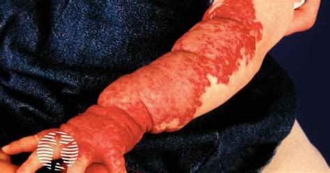 Vascular Malformation Image