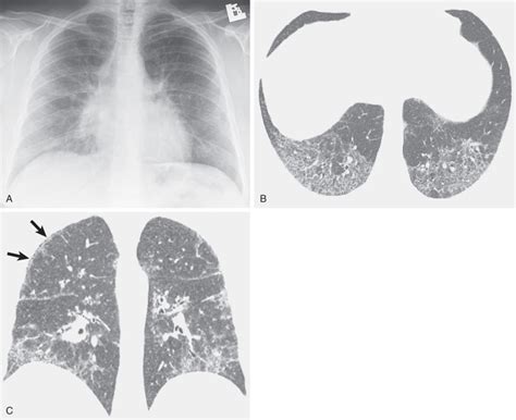 Interstitial Patterns Radiology Key