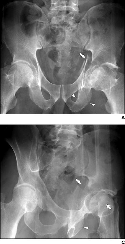 Figure 6 From Classification Of Common Acetabular Fractures Radiographic And Ct Appearances