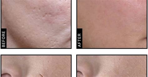 How To Get Rid Of Scars For Good MissLJBeauty