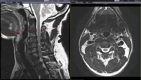 Central Cord Syndrome Mri