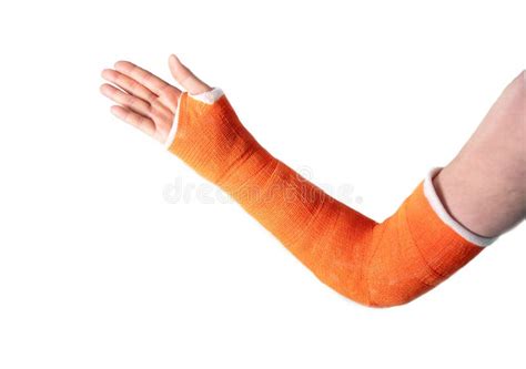 Hand In An Orange Fiberglass Cast After A Fracture Of The Wrist Bones For Fixation On A White