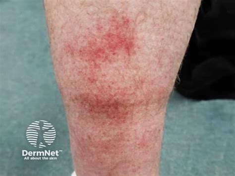 Cellulitis Leg Rash Anaphylactoid Purpura Associated With