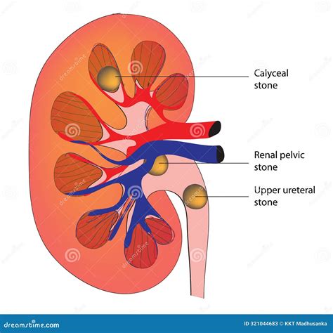 Renal Calculi Cartoon Vector 321044683