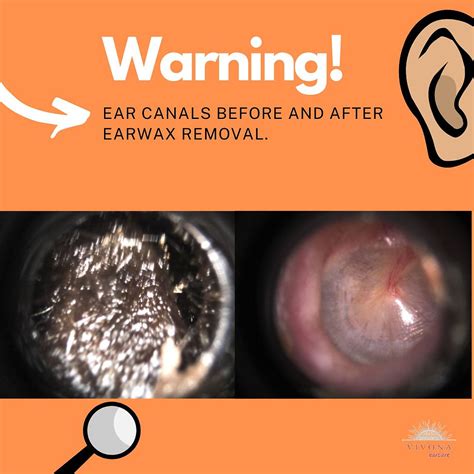 Can Earplugs Cause Wax Blockage At Louis Brannan Blog
