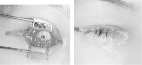 Peptostreptococcus Semantic Scholar