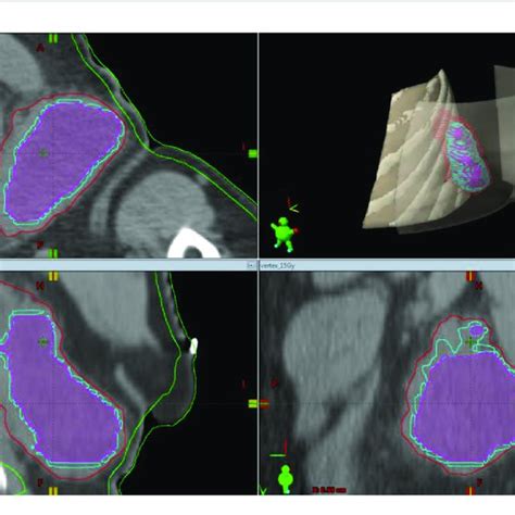 Simulation CT Scan Images In The Axial Top Left Coronal Lower Download Scientific Diagram