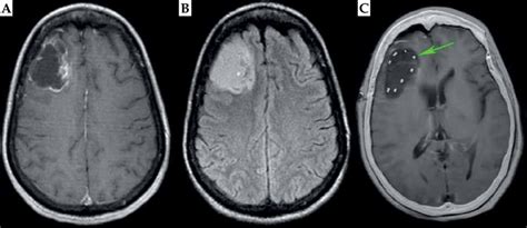 Pre Operative And Post Operative Imaging Of Grade 3 Glioma Axial