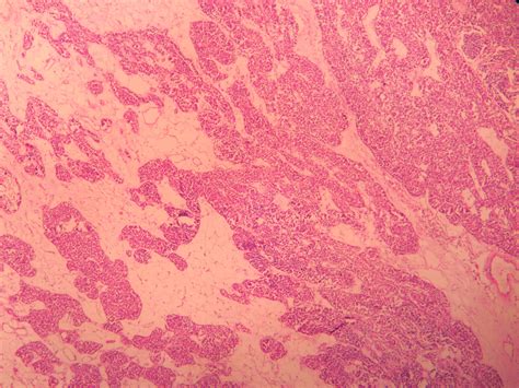 Oncocytoma Histopathology Guru