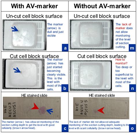 Cell Block Preparation From Cytology Specimen With Predominance Of