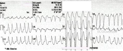 Teaching Series Atrial Fibrillation With Left Bundle Branch Block Ecg Guru Instructor Resources