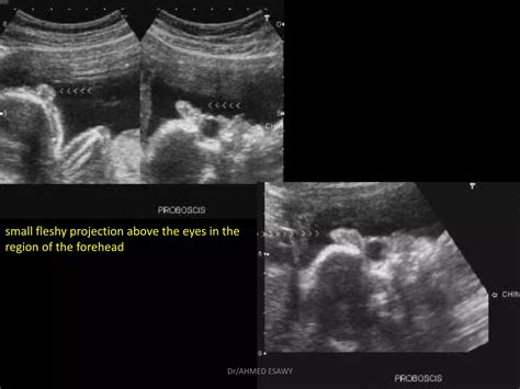 5 Fetal Face Ultrasound Dr Ahmed Esawy Pdf