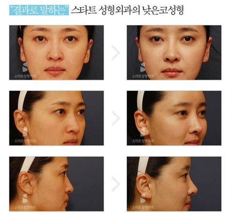 스타트성형외과 얼굴에서 가장 중요한 역할을 하는 중심부는 코 라는것을 알고계신가요 스타트성형외과에서는 환자의 얼굴의 모양과 크기 눈사이의 간격 코와위턱 뼈와관계
