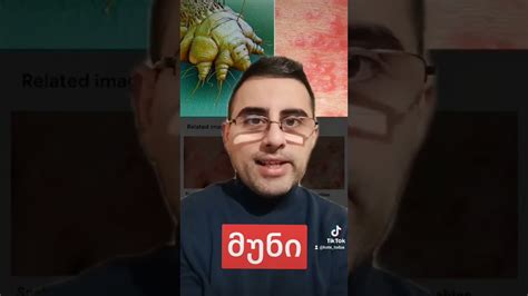 მუნი სიმპტომები და მკურნალობა Youtube