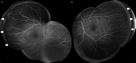 Peripheral Retinal Nonperfusion In Pediatric Patients With Optic Disc