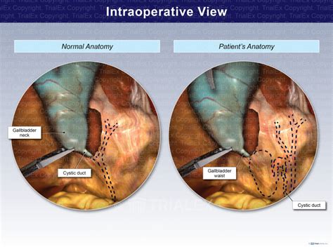 Intraoperative View Comparison TrialQuest Inc