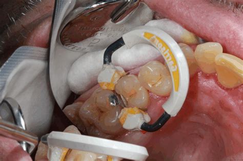 Caries On 13d Restored With Garrison Matrix System And Ecosite Elements