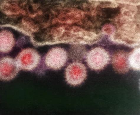 Deadly Eye Bleeding Virus Found In France Could Make Its Way To Uk Daily Star