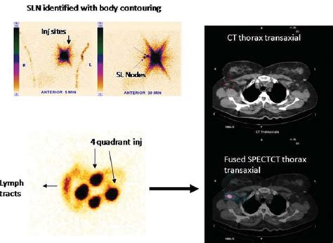 Demonstrates Sentinel Node Imaging Static And Spectct Images Download Scientific Diagram