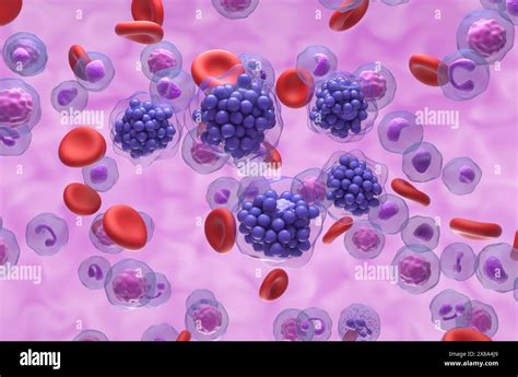Diffuse Large B Cell Lymphoma Dlbcl Isometric View 3d Illustration Diffuse Large B Cell Lymphoma Dlbcl Isometric View 3d Illustration