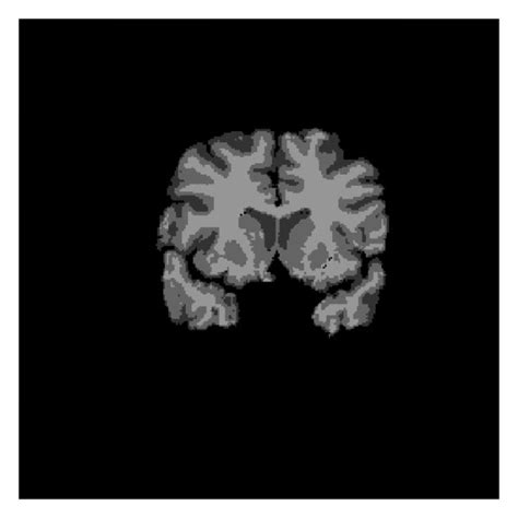 Segmentation Results Of Real Data From Ibsr With The Name 123 39th Download Scientific