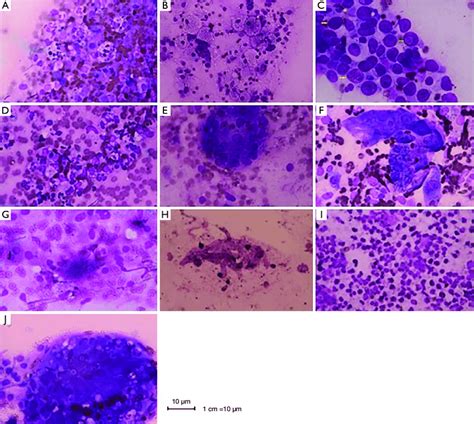 Lung Biopsy Cytology Results Diff Quik Dq Staining Solution Was Used