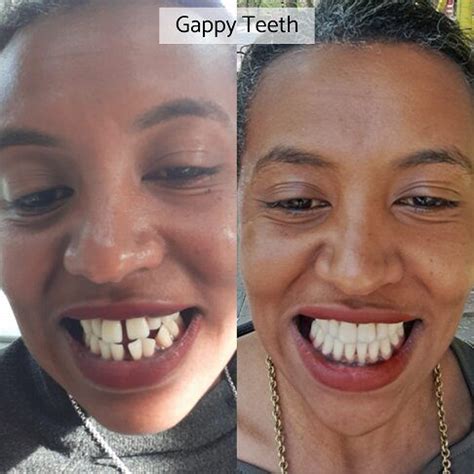 Crooked Teeth Before And After Invisalign