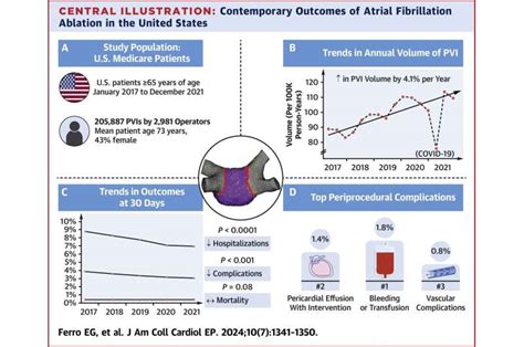 Pulmonary Vein Isolation Is Safe And Effective Treatment Of Irregular Heartbeat Healthmedicinet