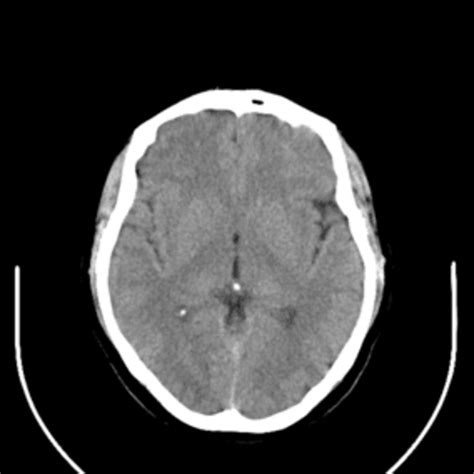 Brain Stroke Ct Dataset Kaggle