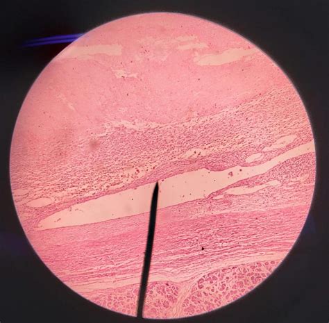 病理学切片 血栓机化与再通、慢性肺淤血