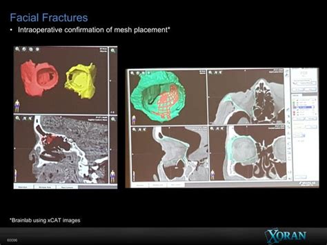 Xorans Xcat High Resolution Low Dose Head Ct Pdf