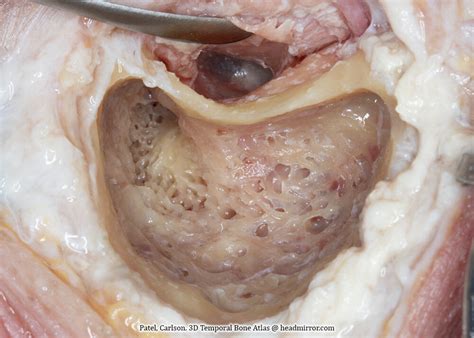Postauricular Approach — Headmirror