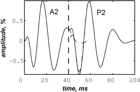 Simulated S2 Heart Sound A2 P2 Valvular Split 40 Ms Download Scientific Diagram