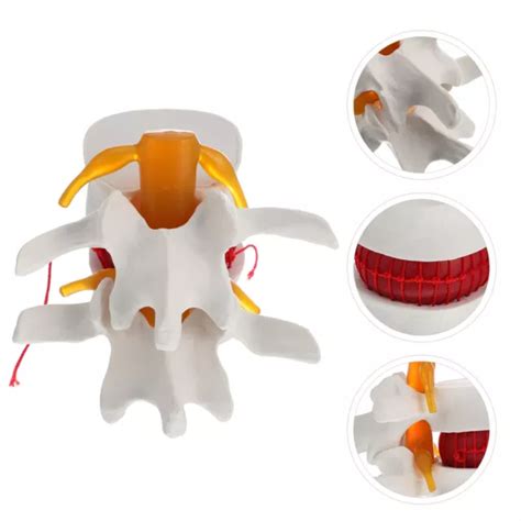 Spine Model Vertebra Pathology Lumbar Learning Disc Herniation Presentation £21 59 Picclick Uk