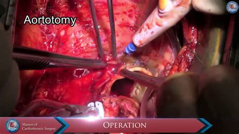 Multiple Valve Endocarditis A Hemi Commando Procedure Youtube